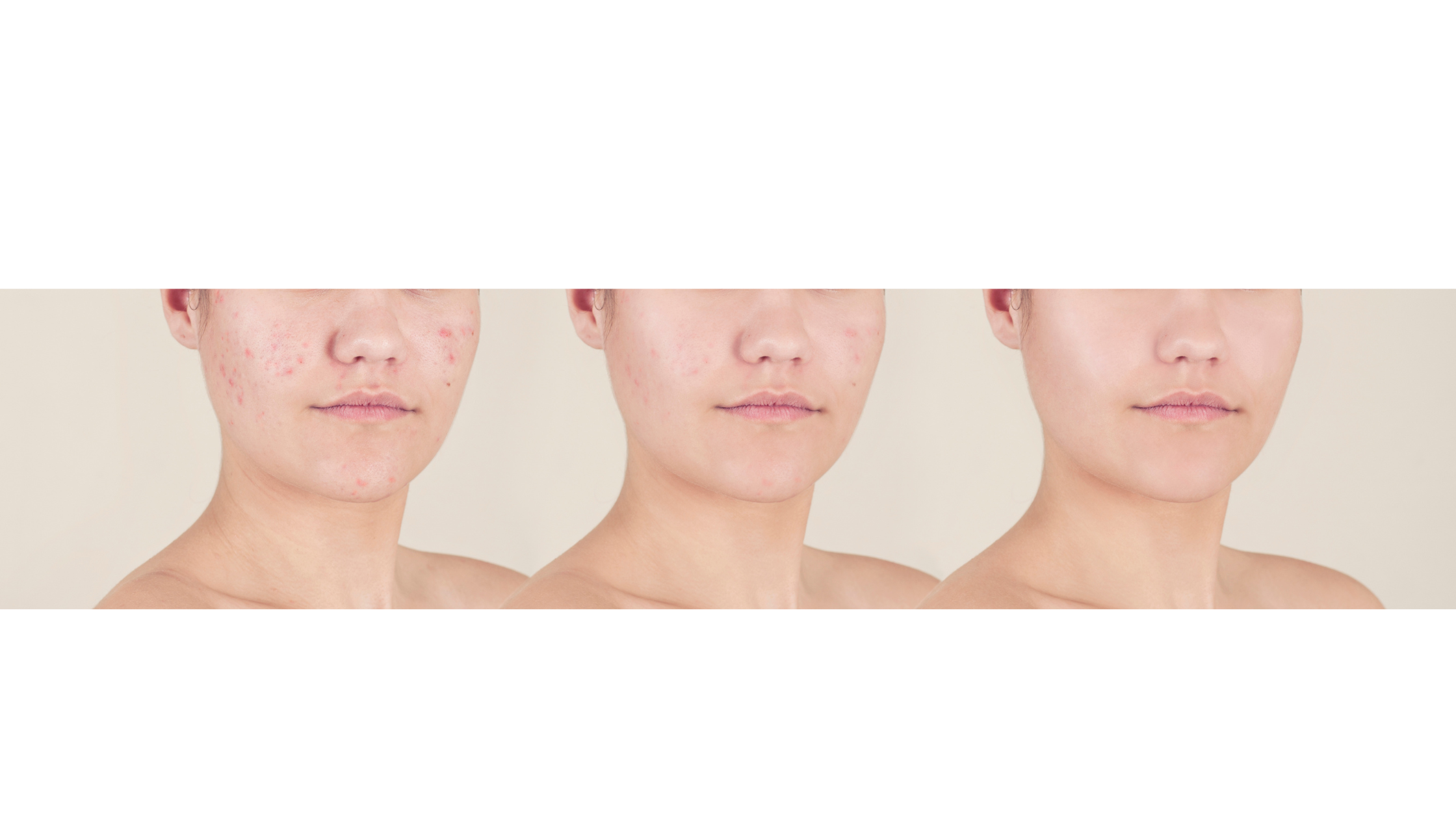 Catching Acne Early: How to Spot and Treat Pre-Breakout Skin | Beauty ...